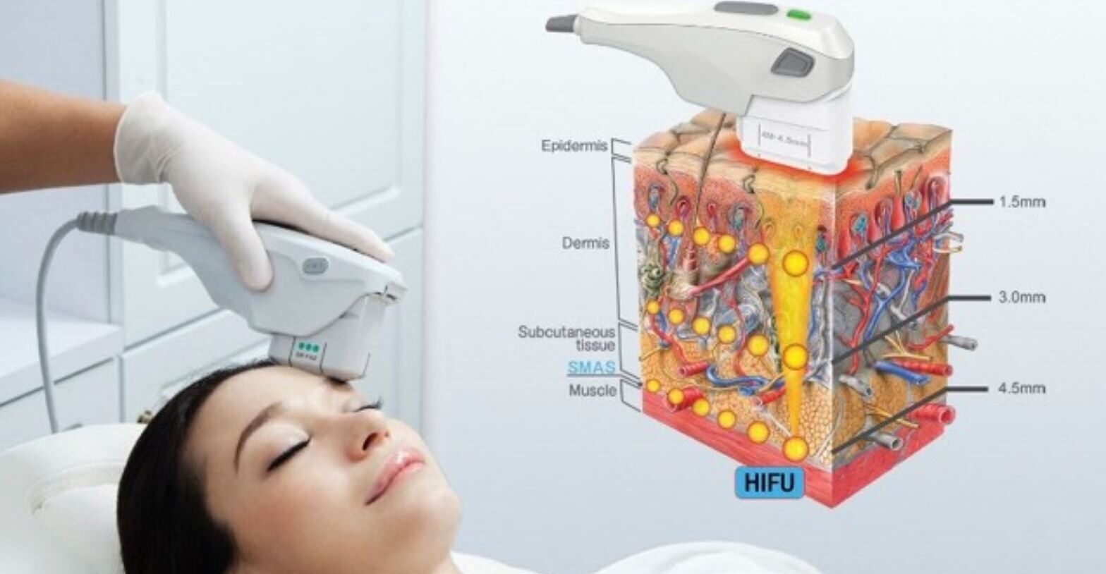 HIFU Facelift in Sutton Coldfield, Birmingham | The Aesthetic Labs